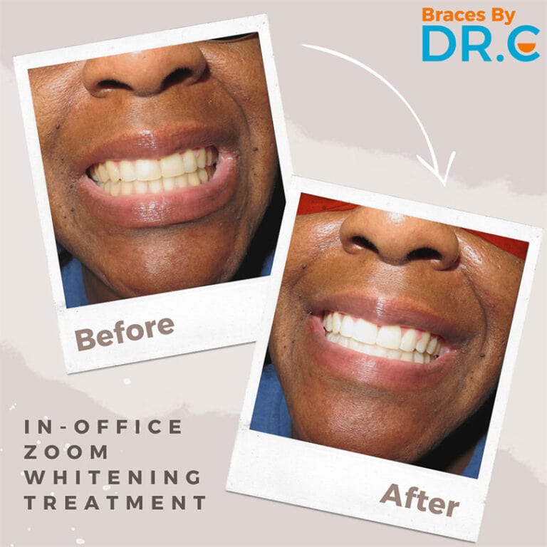 Other Treatments - Braces By Dr. C